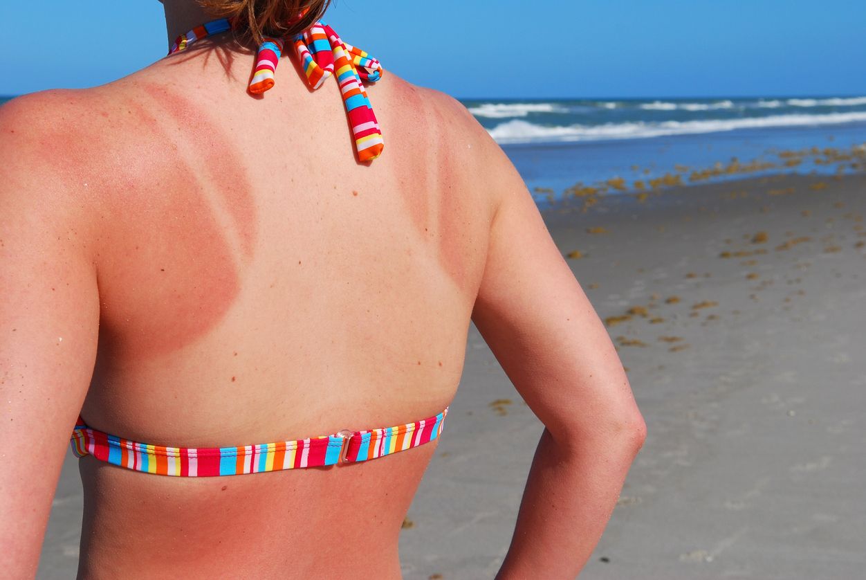 Why Do We Get Sunburned Trivia Genius